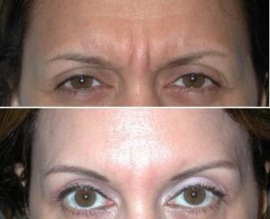 BOTOX® Cosmetic Boulder CO